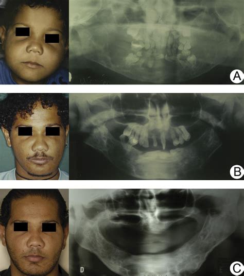 Cherubism Clinicoradiographic Features Treatment And Long Term