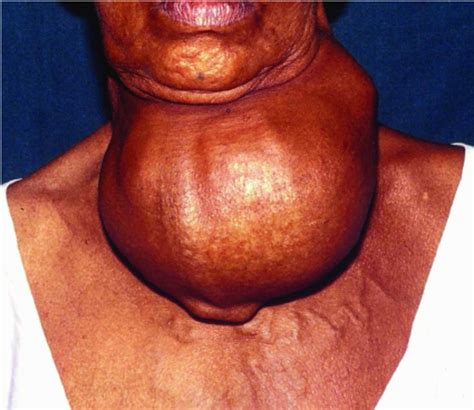 Post Total Thyroidectomy Specimen Revealing Gland Weighing 824 Grams