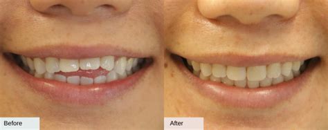 Invisalign Before And After Cases You Need To See
