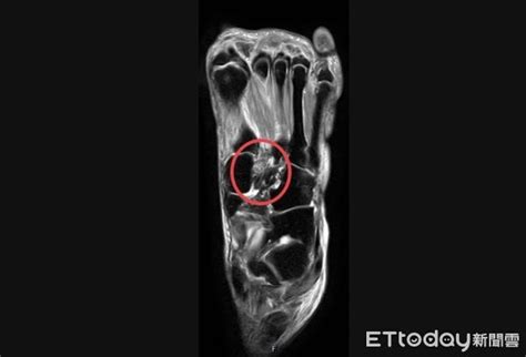 王建民翻版馬拉松男踩空仆街 腳踩超痛才知韌帶受傷 ETtoday健康雲 ETtoday新聞雲