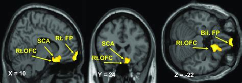 Resting State Functional Connectivity Of The Right Anterior Insular Resting State Functional Connectivity Of The Right Anterior Insular