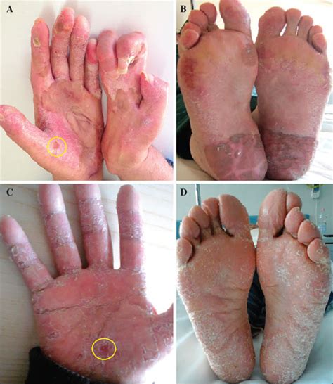 Jle European Journal Of Dermatology Rspo1 Mutated Fibroblasts From Non Tumoural Areas Of