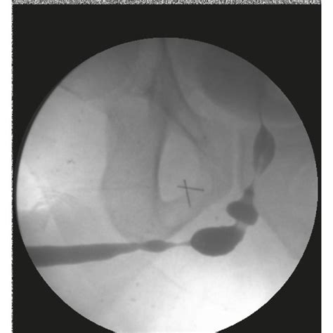 Rgu Demonstration Of A Bulbar Stricture 45 Fr And Download