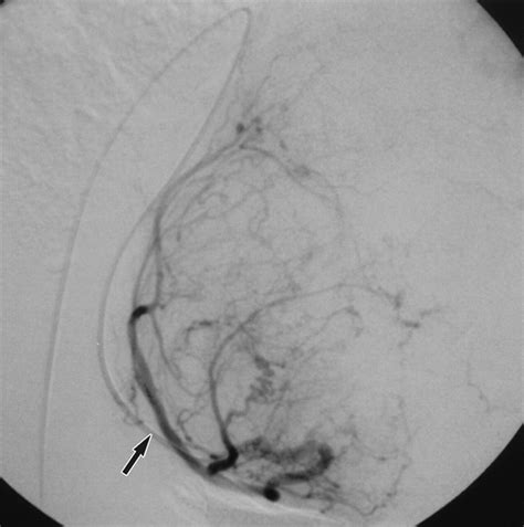 Emergency Selective Arterial Embolization For Control Of Life