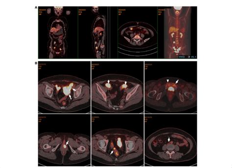 Target Lesions Of The Patient With Uterine IMT By PET CT Scans A B Download Scientific