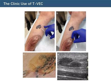 Introduction To Oncolytic Viruses Ppt