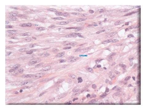 Sarcomatous Component Visible On Hpe Download Scientific Diagram
