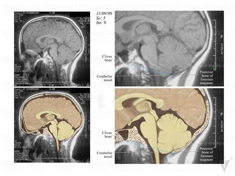 Tonsillar Herniation