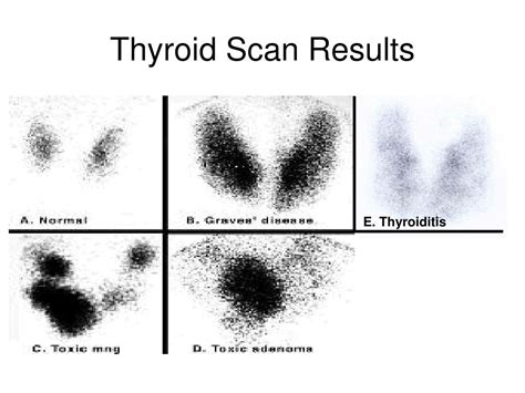 Ppt Everything You Ever Wanted To Know About The Thyroid But Were