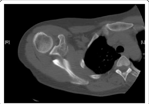 Ct Scan Showing The Metastatic Lesion At The Base Of The Coracoid Download Scientific Diagram