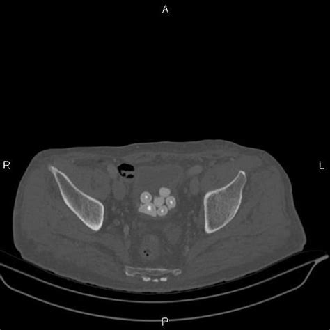 Bladder Calculus Pacs