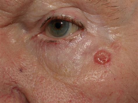Skin Cancer Basal Cell Cancer And Melanoma Malignant Melanoma