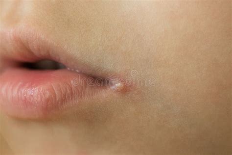 Skin Problems Angulitis Angular Stomatitis Angular Cheilitis A