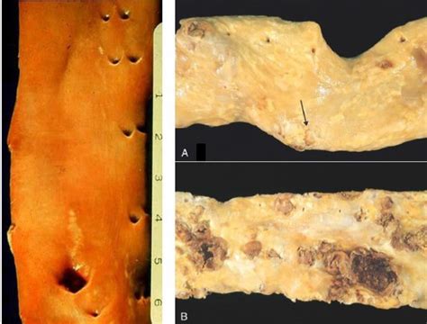 Pathology Exam CVS Flashcards Quizlet