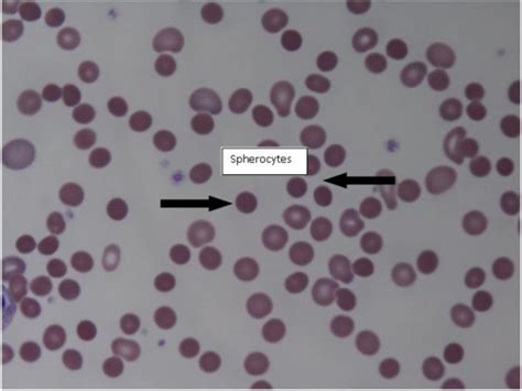 Normocytic Anemias Flashcards Quizlet