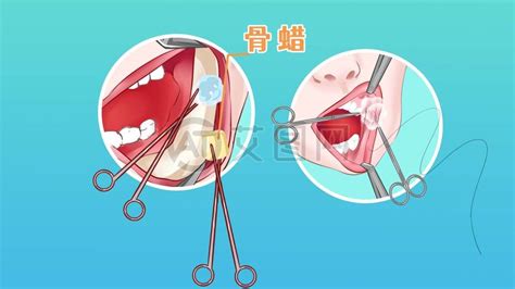 骨蜡 削骨 整形 手术 口腔医疗图片素材高清图片素材