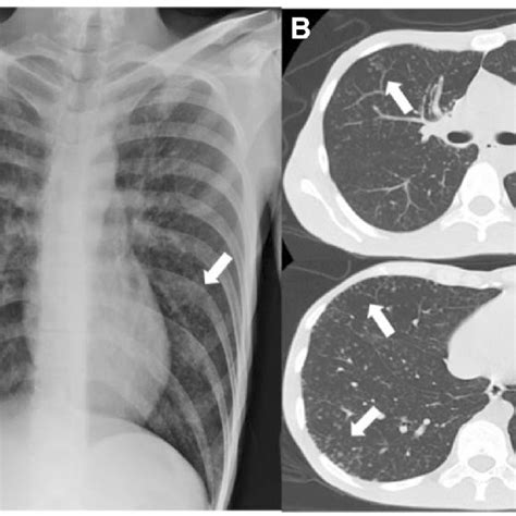 Patient Images Showing Random Distribution Of Micro Nodular Opacities Download Scientific