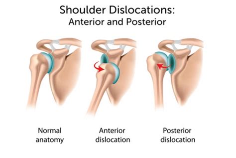 Shoulder Subluxation Versus Dislocation Which Sports Do These Occur In And What Is The