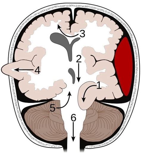 Brain Herniation • Litfl • Ccc Neurology