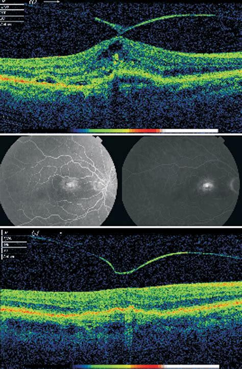 Re Oct Scan 3 Weeks After Ocriplasmin Injection Dissolving Download Scientific Diagram