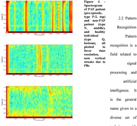 Figure 1 From Prediction Of Paroxysmal Atrial Fibrillation Paf Onset Through Analysis Of Inter