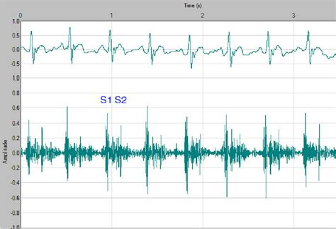 Phonocardiogram Microphone Clipart