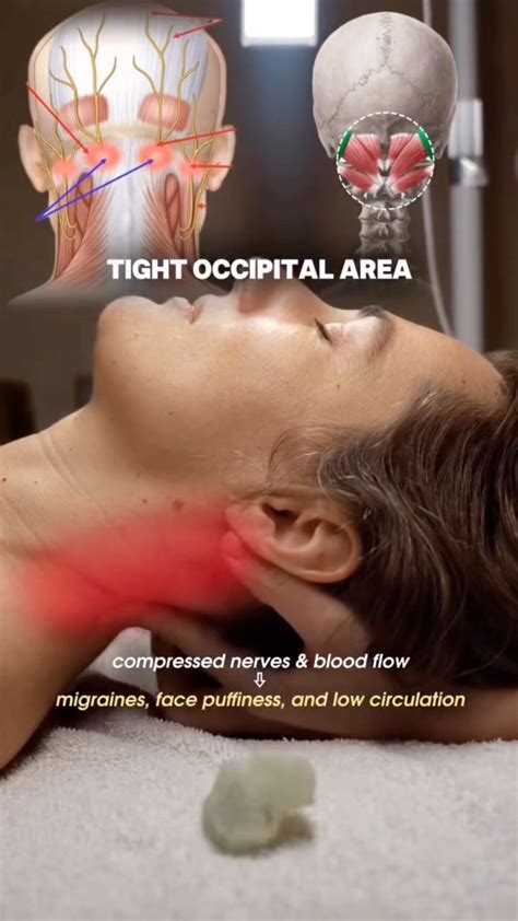 Tight Suboccipital Muscles At The Base Of Your Skull Can Trigger