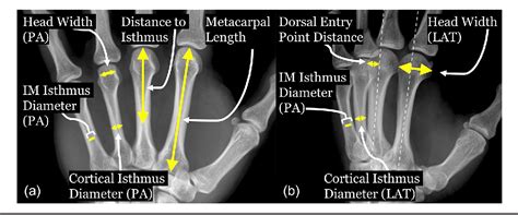Figure 1 From Intramedullary Headless Screw Fixation Of Metacarpal Fractures A Radiographic