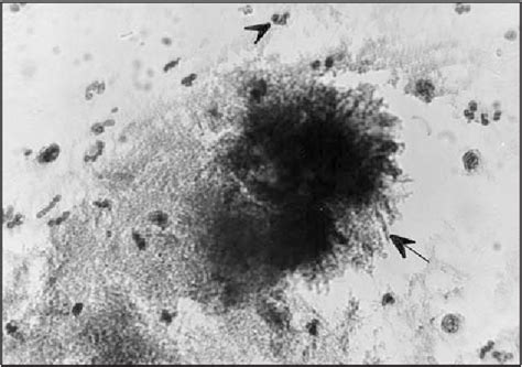 Figure 1 From Cytologic Findings In Pap Smears With Actinomyces Like