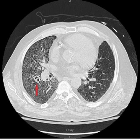 CT Lungs Showing Diffuse Micronodular Changes In Right Lung In Download Scientific Diagram