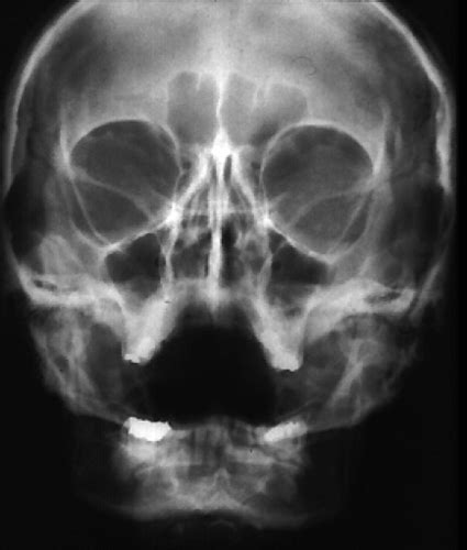 Ost 580 Lecture 23 Normal Sinus Anatomy Sinus X Ray Views And Sinus
