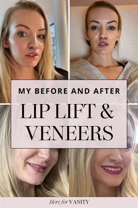 My Lip Lift And Veneers Before And After Plastic Surgery Lips