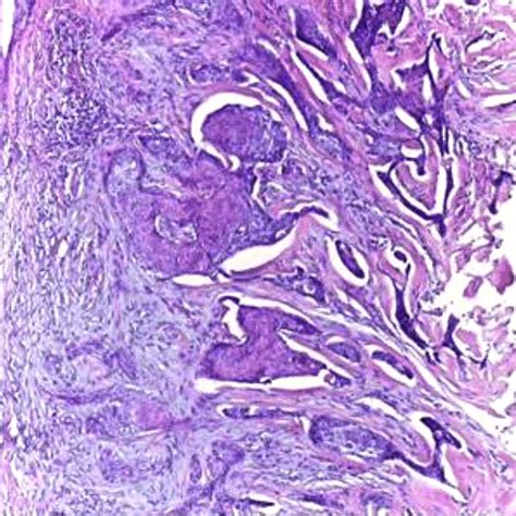Histopathological Examination Of 2010s Recurrence A Tumor Composed