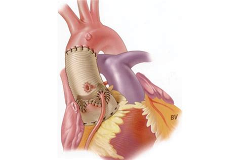 Aortic Root Replacement Surgery In Mumbai Dr Biswa Panda