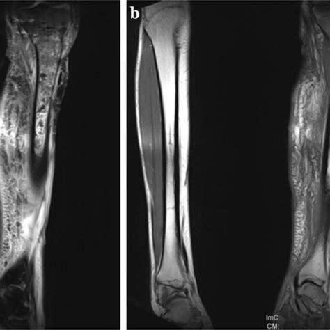 X Rays At First Admission Ao Type 41 A2 Anderson Gustilo Iiib