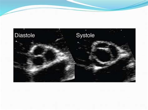 Aortic Stenosis Echocardiography Pptx