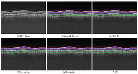 Retinal Layers Oct