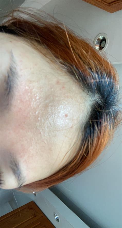 Help What Are These Bumps On My Forehead And How Do I Get Rid Of Them R Skin