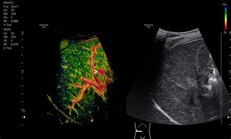 Splenic Infarction An Ultrasonographic Diagnosis March 2025 Efsumb