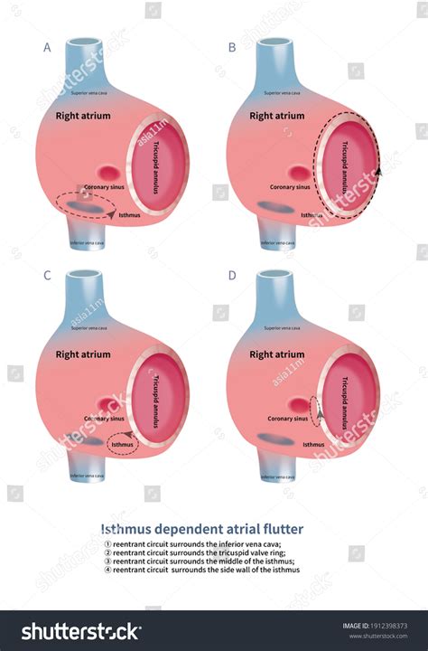 Typical Atrial Flutter Reentry Loop Runs Stock Illustration 1912398373