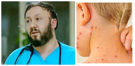 როგორ უნდა მიხვდეს მშობელი რომ ჩუტყვავილა რთულდება ეს საკმაოდ სერიოზული სიმპტომებია და