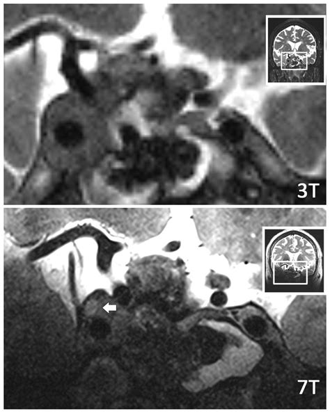 Characterization Of A Macroadenoma Within The Right Cavernous Sinus And