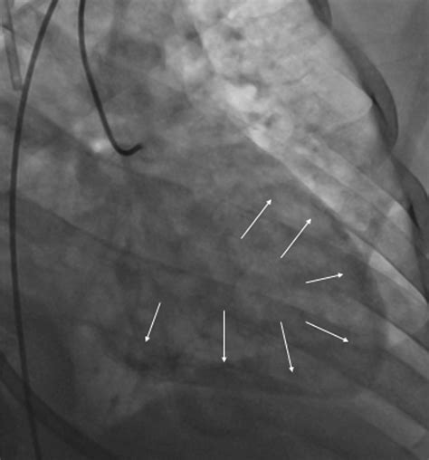 Multimodal Imaging To Understand Left Ventricular Systolic Dysfunction In A Patient With Sepsis