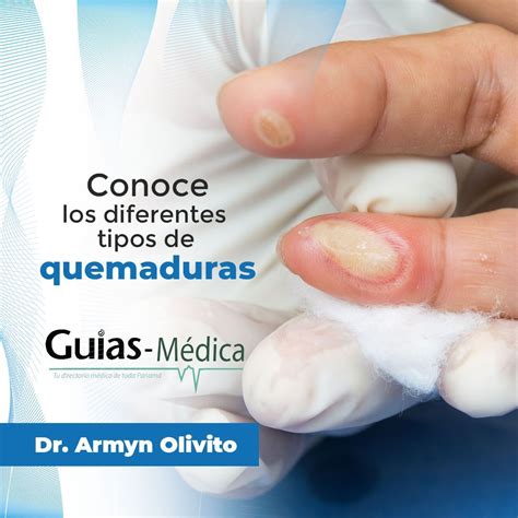 Conoce Los Diferentes Tipos De Quemaduras Guía Médica