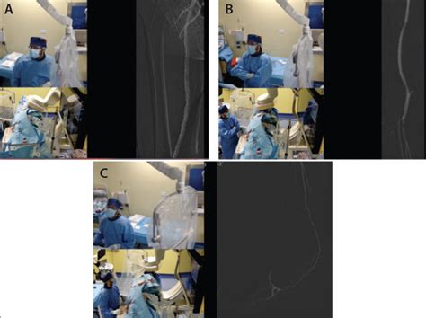 Retrograde Access For Stenting Of The Sfa Ostium Endovascular Today