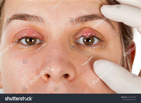 Upper Eyelid Stye