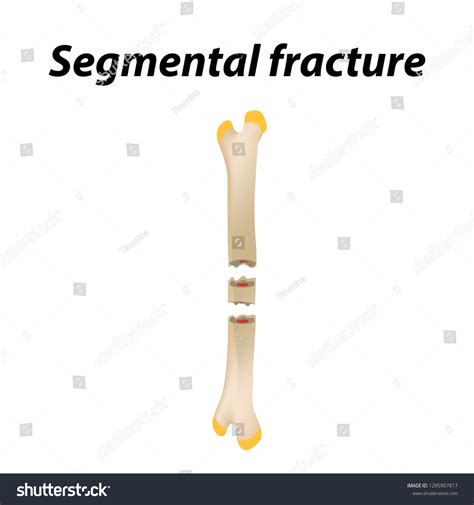 Segmental Fracture Bone Infographics Vector Illustration Stock Vector