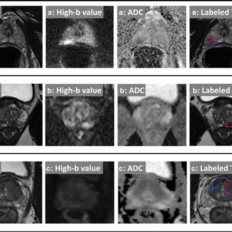 Case Examples From Left To Right T2w Dwi High B Value Adc Map And