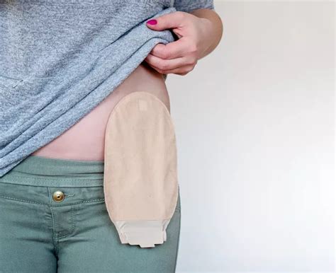 Sigmoid Colectomy Colorectal Cancer Alliance