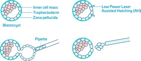 Biopsy PGT Superior A R T
